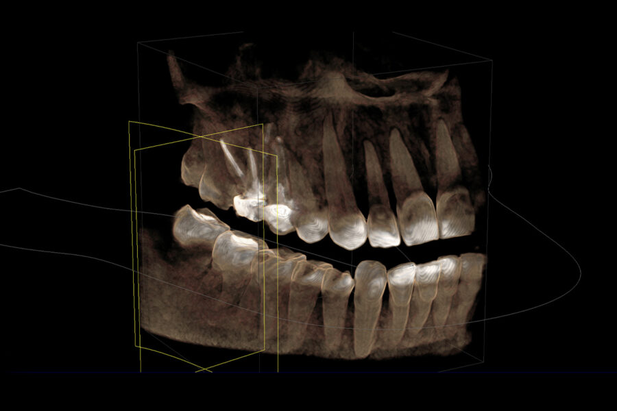 Emergency Endodontist in Morrisville, NC | Root Canal | ReGen Endodontics